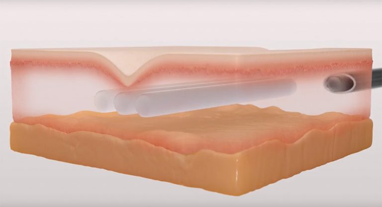 Filler Fatigue | Bellafill® for Smile Lines & Acne Scars