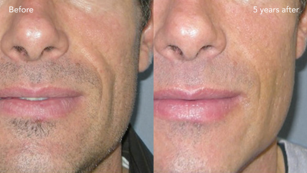 before-after1 | Bellafill® for Smile Lines & Acne Scars